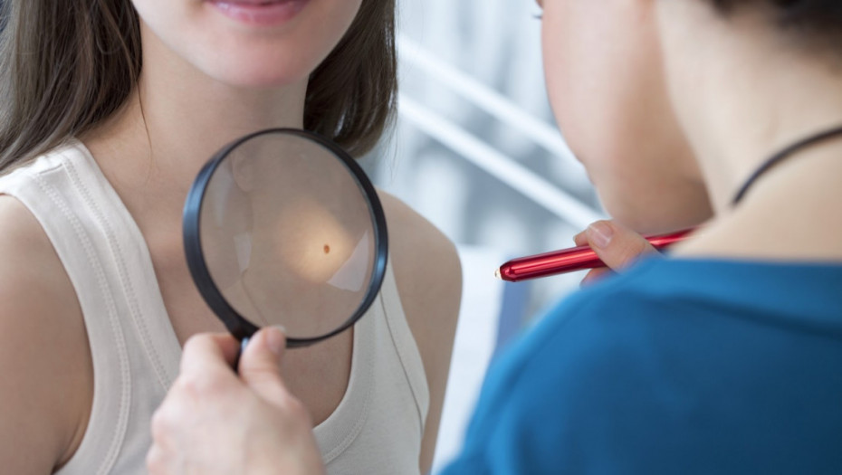 Mesec borbe protiv melanoma: Ko spada u rizične grupe i šta je osnovna prevencija